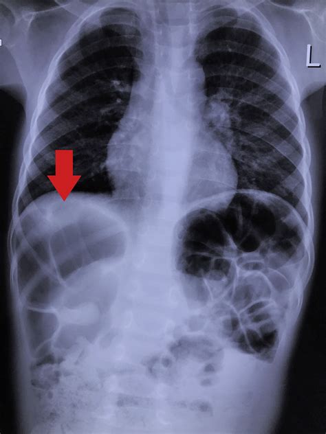 Chilaiditi Syndrome—whats Air Doing There Journal Of Emergency Medicine