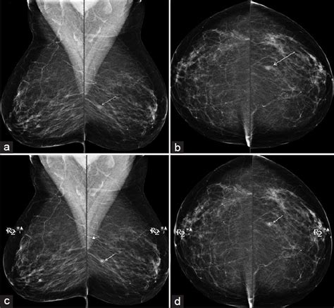 CAD May Not Be Necessary For Microcalcifications In The Digital Era CAD May Benefit