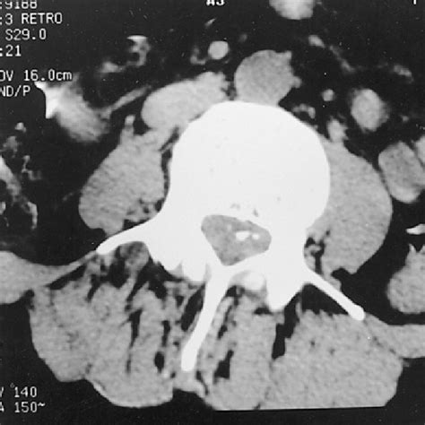 Pdf Spinal Cord And Spinal Dural Arteriovenous Fistulas And Intradural Calcification