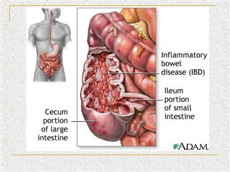 Etiology Lower Gi Bleed Ppt