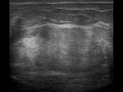 Breast And Axilla 51 Benign Lesions Case 517 Lipomas