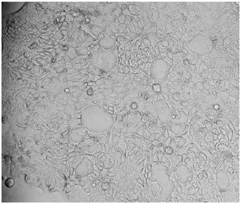 Human Intrahepatic Cholangiocarcinoma Cell Line With High Tumorigenic