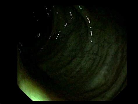 Some Bad Examples Of Colonoscopy Frames Download Scientific Diagram