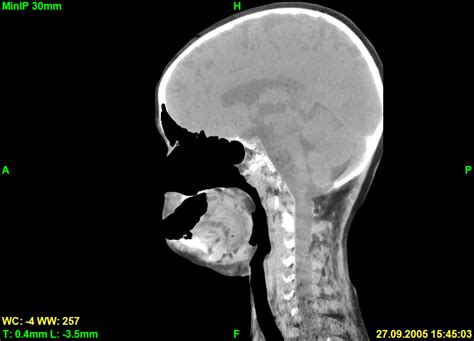 Dicom Multiplanar Reconstruction
