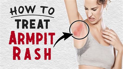 How To Treat Armpit Rash At Home Home Remedies For Armpit Rash Treatment Youtube