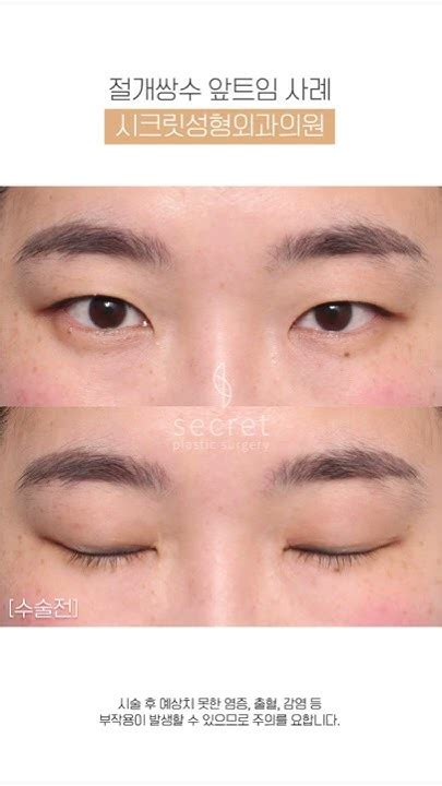 절개 쌍수 붓기 빠지는 과정 Shorts Youtube