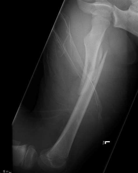 Pediatric Femur Fractures Core Em
