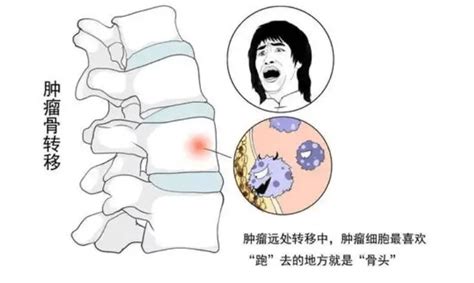 癌症骨转移前身体会发出这些求救信号尤其是高危关键期 骨骼