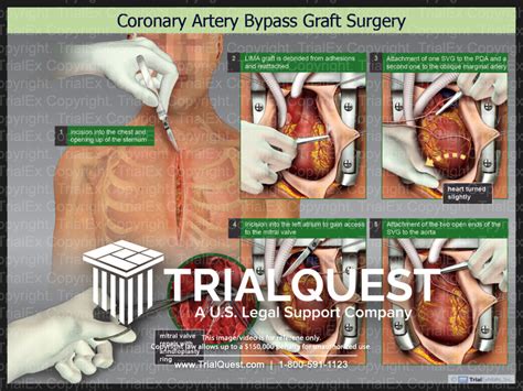 Coronary Artery Bypass Graft Surgry Trialquest Inc