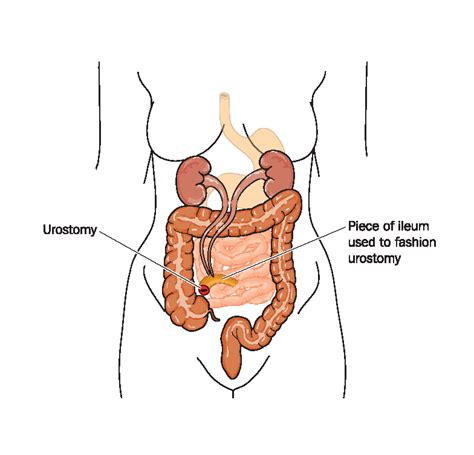 Urostomy Ostomy New Zealand