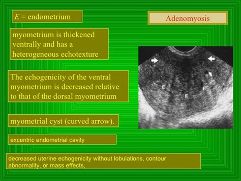 Adenomyosis