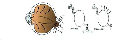 Diagram Of Glaucoma Pathogenesis The Reduced Outflow Or The Download Scientific Diagram