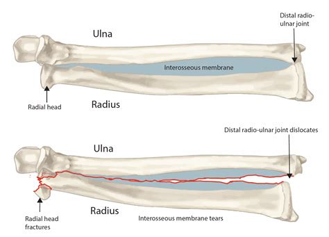 Interosseous Membrane Arm