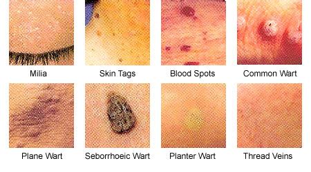 Skin Condition About Warts