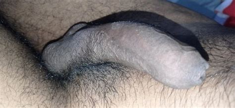 Penis Phimosis And Peyronies 6 Pics Xhamster