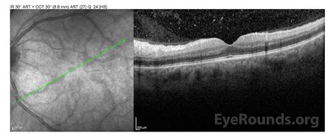 Bilateral Acute Retinal Necrosis