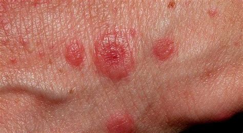 Eritema Multiforme Nedir Nedenleri Belirtileri Ve Tedavisi