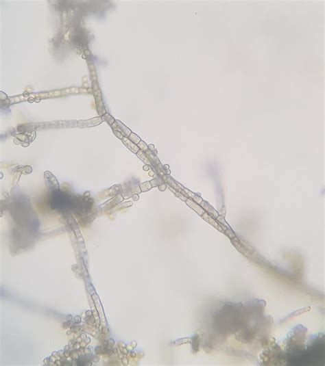 Jock Itch Fungus Microscope Patient Education Ringworm Including