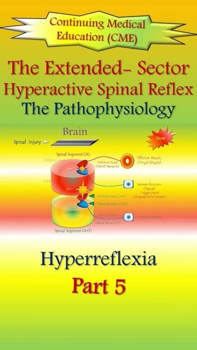 The Hyperreflexia 5 The Extended Hyperactive Spinal Reflex Youtube