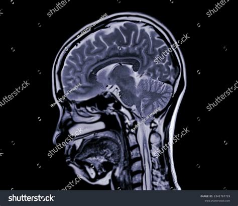 Sagittal Plane Brain