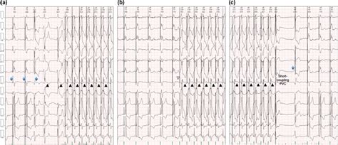 Episodes Of Rbbb Pattern Pma In Ambulatory Ecg Monitoring The