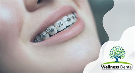 What Are Braces All You Need To Know Wellness Dental Dentagama