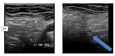 Direct Inguinal Hernia Ultrasound