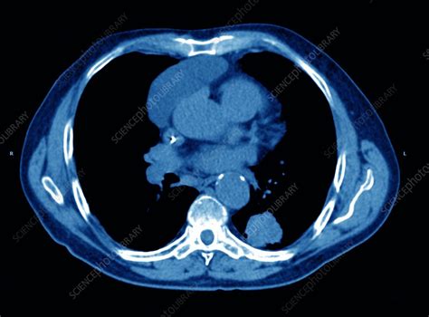 What Do Lung Nodules Look Like On Ct Scan Ct Scan Machine