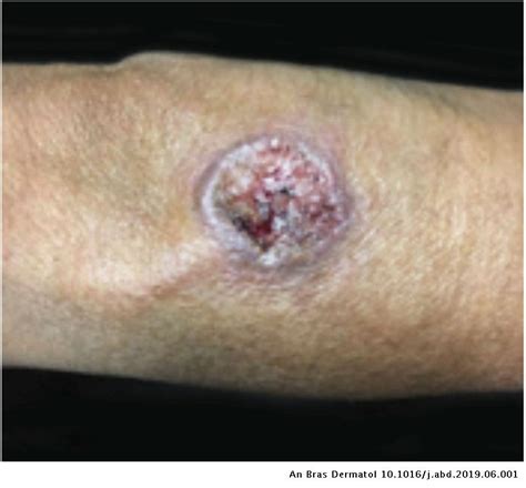 Early Pyoderma Gangrenosum