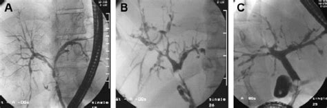 Typical Examples Of Psc Cholangiograms A Type I Intrahepatic