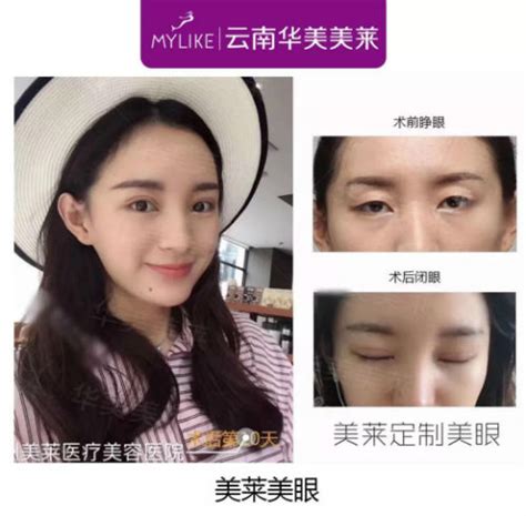 昆明割双眼皮哪家医院比较好昆明美莱整形美容医院