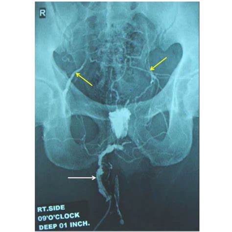 St Jamess University Hospital Mr Imaging Classification Of Fistula In Download Scientific