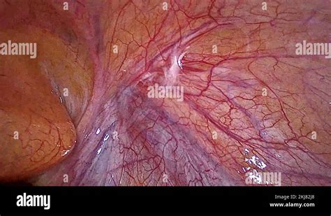 Appendicitis Surgery View From The Surgical Camera Of The Process Of