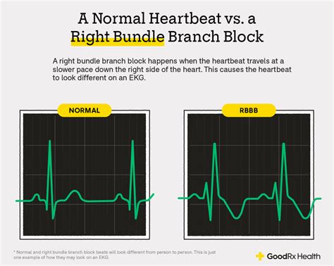 Rbbb And Ekgs Diagnosing Right Bundle Branch Blocks Goodrx