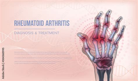 Rheumatoid Arthritis Banner Hand Joints Deformation Stock Vector Adobe Stock