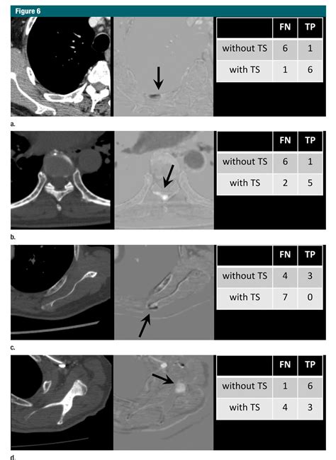 Figure 6 From Temporal Subtraction Of Serial Ct Images With Large Deformation Diffeomorphic