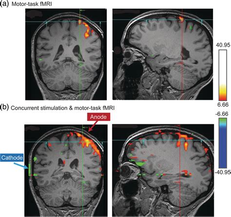 Concurrent Stimulation And Imaging Artifact Fmri Activation During Hand
