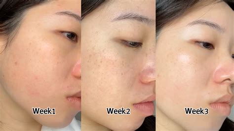 Kojic Acid Cream Before And After