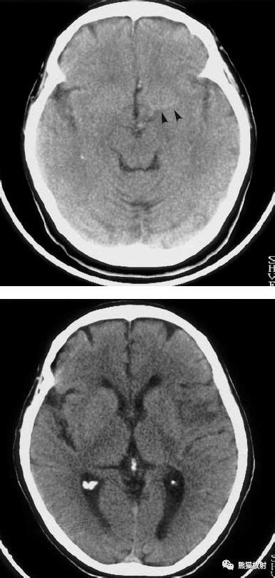 一文全脑梗死 演变血供区域分布CT表现 MedSci cn