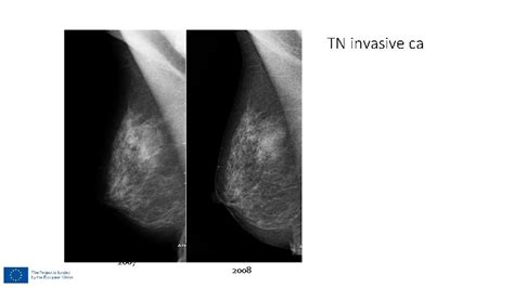 Birads Classification In Mammography Dr Egle Jonaitiene Dr