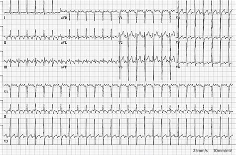 심혈관 부정맥빈맥 부정맥 문제1 네이버 블로그