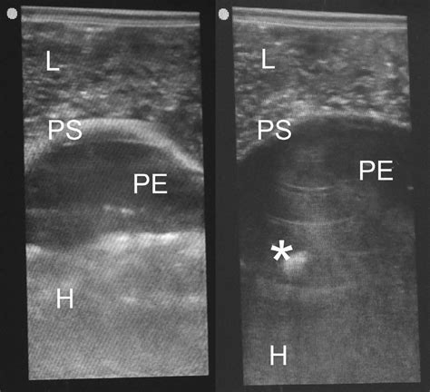 Ultrasound Images From Centesys Showing Left Subxiphoid Window Download Scientific Diagram
