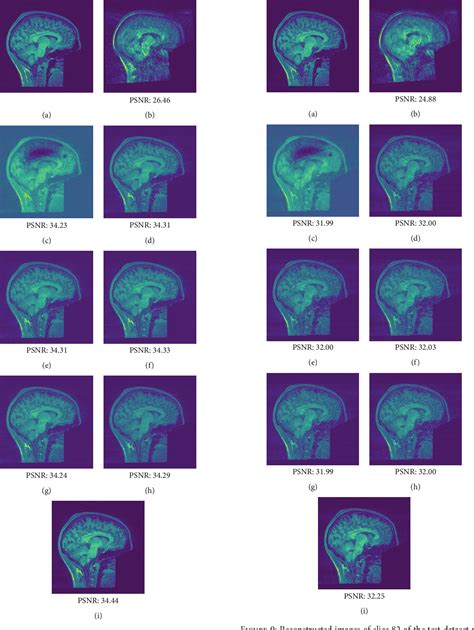 Figure 9 From Swin Transformer And The Unet Architecture To Correct Motion Artifacts In Magnetic