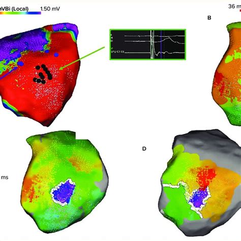 Substrate Ablation And Ventricular Tachycardia Activation Mapping Of Download Scientific
