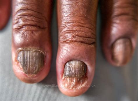 Onychomycosis Nurses Revision