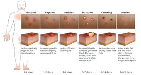 Clinical Features Of Mpox Mpox Cdc