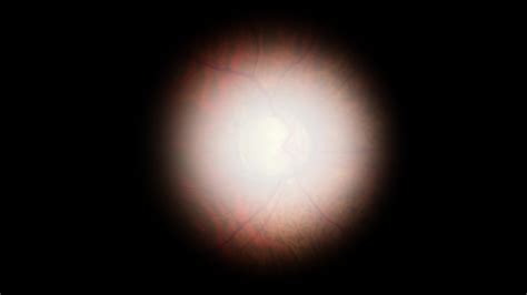 Glaucoma Clinical Challenge Page