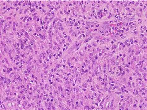 Figure 2 From Mycobacterial Spindle Cell Pseudotumor Semantic Scholar