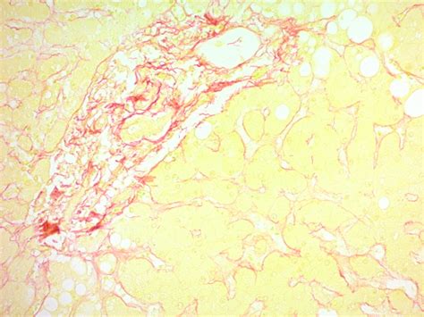 Picro Sirius Red Histology Stain Kit For Collagen