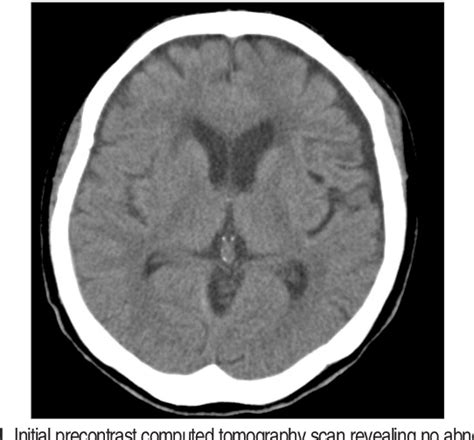 Figure 1 From Escherichia Coli Subdural Empyema Following Subdural Hygroma In Elderly Patient